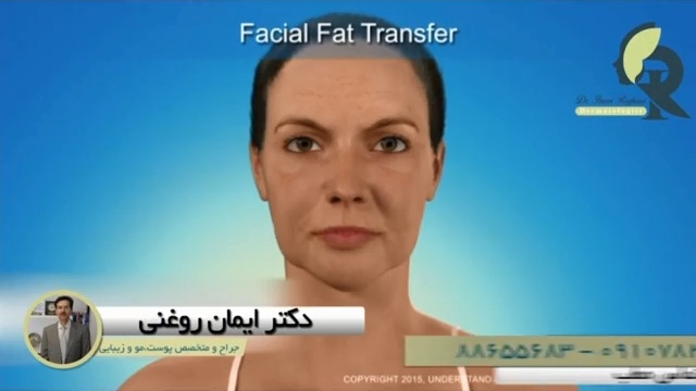 تزریق چربی به صورت و جوانسازی نماشا