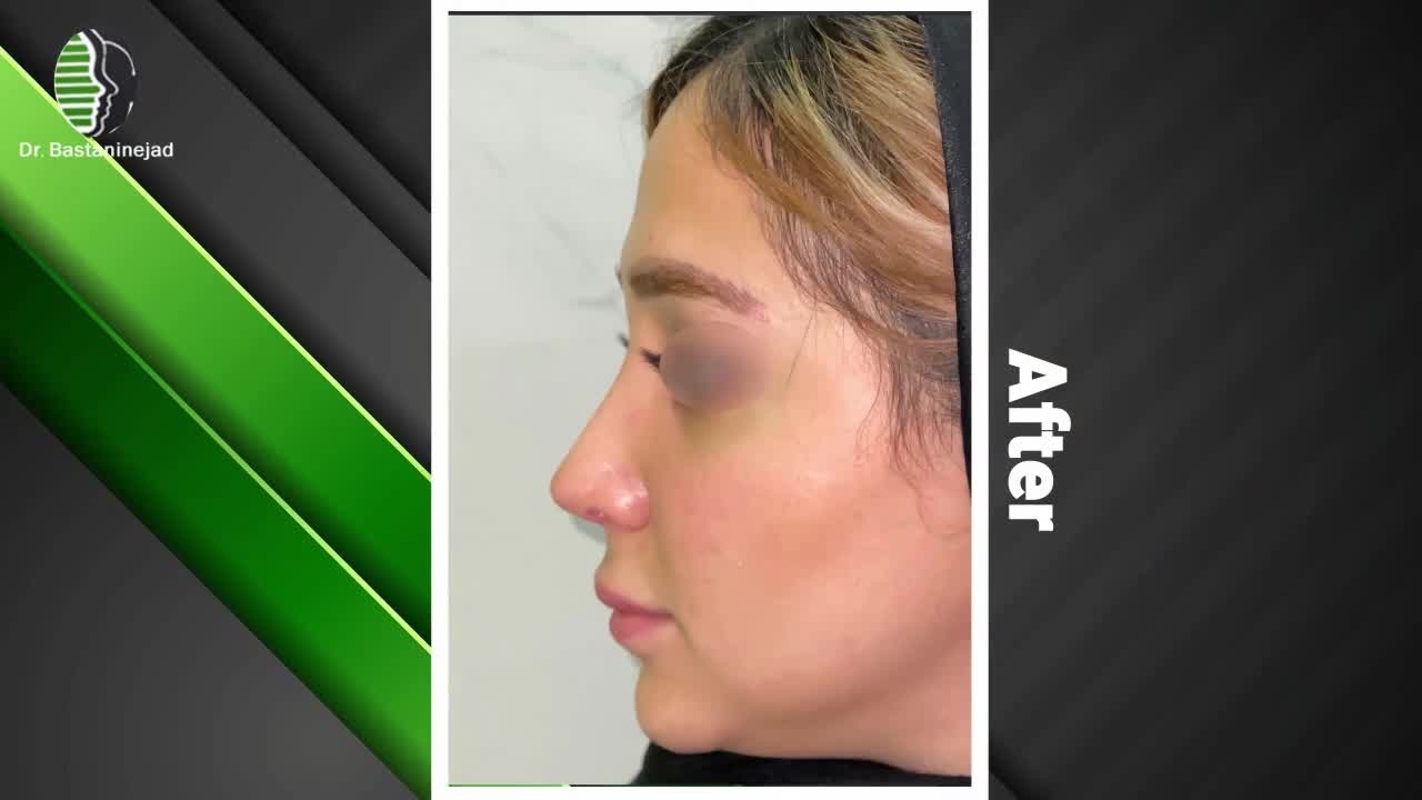 شش ماه بعد از جراحی زیبایی بینی به فرم باکسی دکتر باستانی نژاد نماشا
